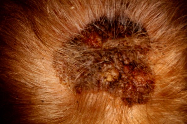 Seborhic Keratosis | Seborrheic | Comprehensive Dermatology Photo Atlas ... Seborhic Keratosis | Seborrheic | Comprehensive Dermatology Photo Atlas ...